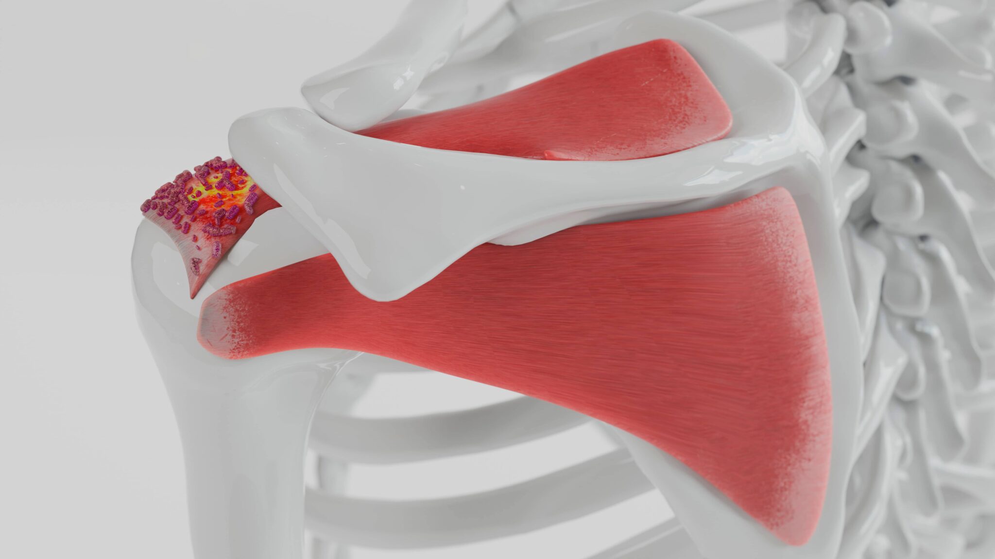 Learn how the Shoulder Barbotage Procedure Treats Shoulder Pain