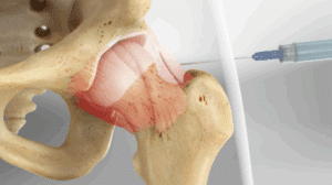 Long-Lasting Pain Relief with Cortisone Injections | Burnley